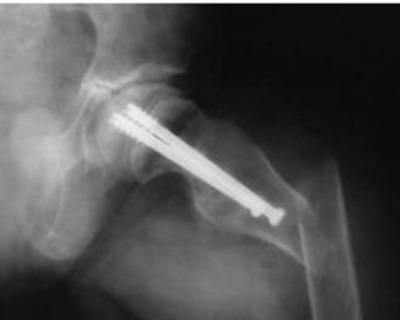 El tratamiento de la patología de la Epifisiolisis. - Angel Camp ...