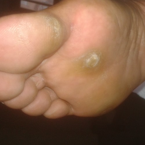 Hiperqueratosis (callos y durezas) - Angel Camp Podologo en Valencia